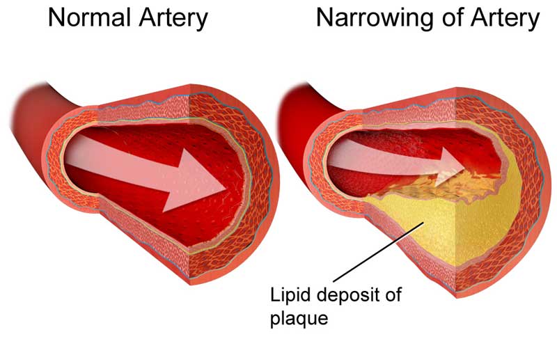 Cholesterol - Medcare SpainMedcare Spain